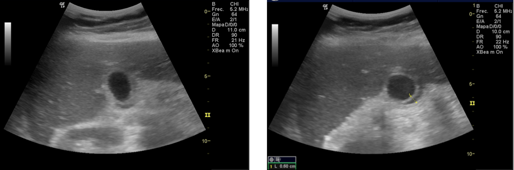 Líquido perivesicular - Ecografía Clínica - FESEMI
