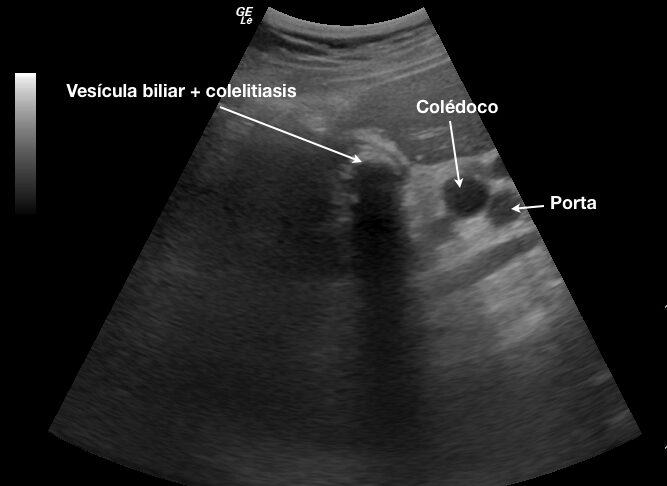 4.2.3. Coledocolitiasis y dilatación de la vía biliar Archives ...