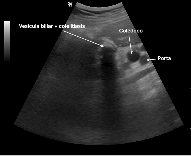 Colelitiasis múltiple - Ecografía Clínica - FESEMI