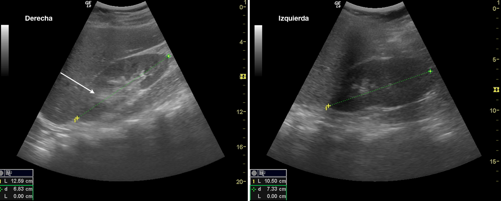 Alteración de la ecogenicidad - Ecografía Clínica - FESEMI