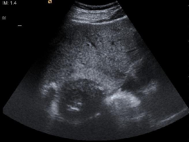 Quiste hidatídico hepático - Ecografía Clínica - FESEMI