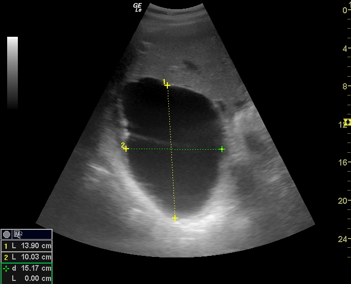 Quiste hepático - Ecografía Clínica - FESEMI