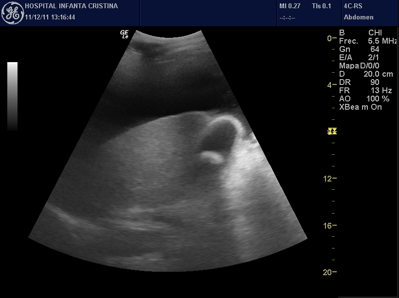 Colelitiasis en paciente con ascitis - Ecografía Clínica - FESEMI