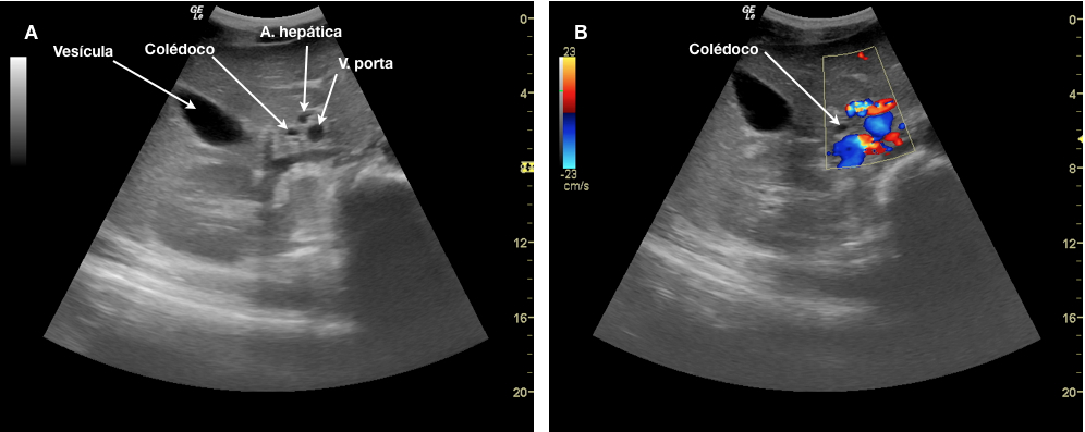Colédoco normal - Ecografía Clínica - FESEMI