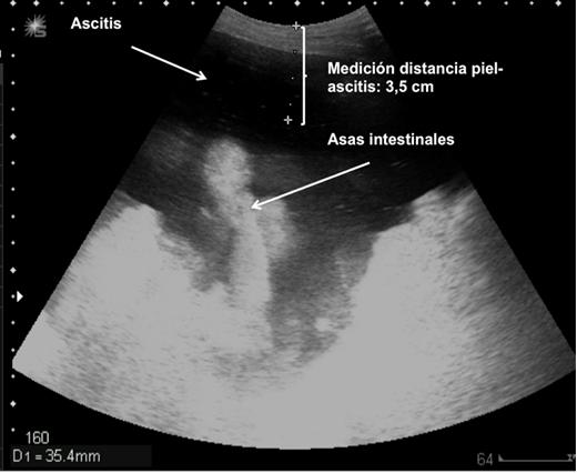 Ascitis en paciente con cirrosis hepática - Ecografía Clínica - FESEMI