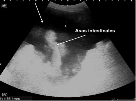 Gran cantidad de ascitis en paciente con cirrosis hepática y ...
