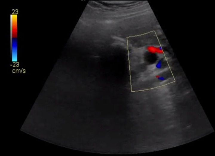 Dilatación del colédoco - Ecografía Clínica - FESEMI
