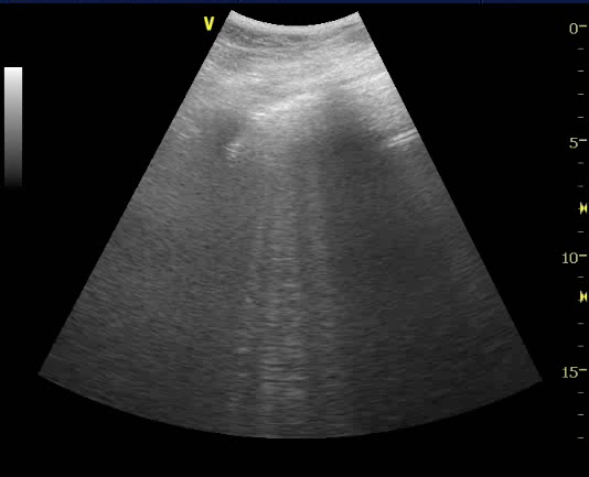 Líneas B - Ecografía Clínica - FESEMI