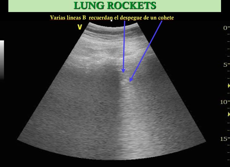 Lung Rockets - Ecografía Clínica - FESEMI