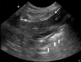 Shred sign - Ecografía Clínica - FESEMI