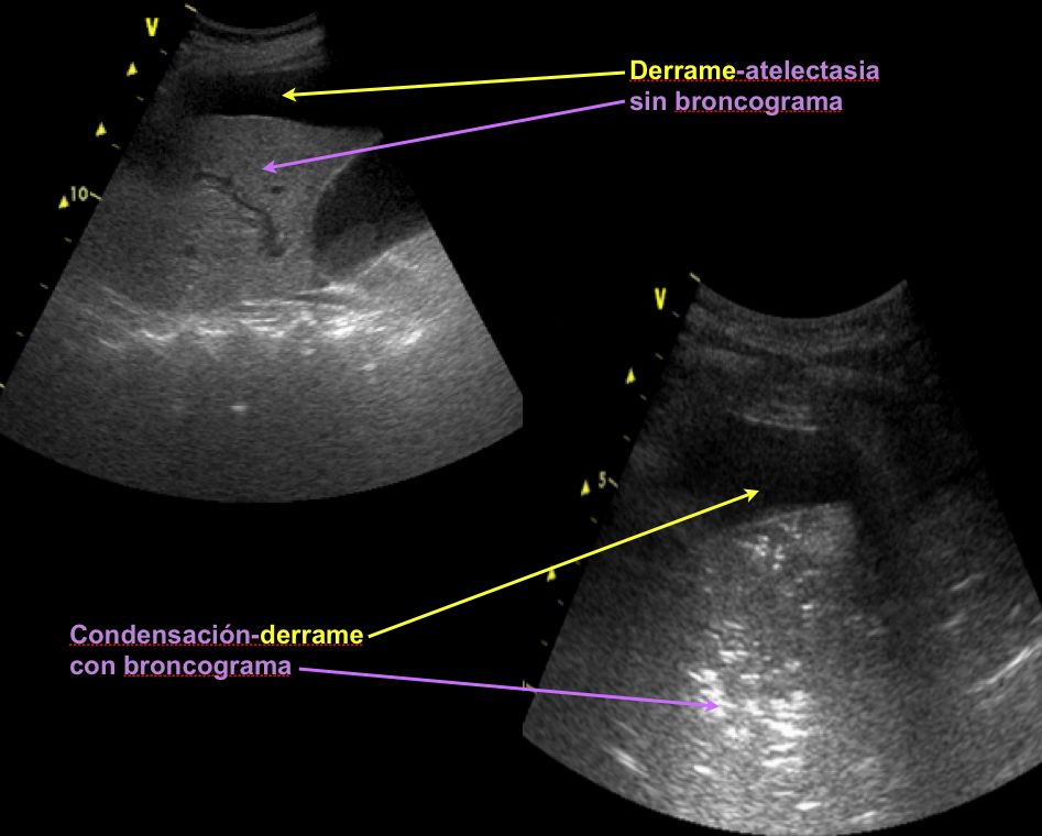 Atelectasia y/o condensación - Ecografía Clínica - FESEMI