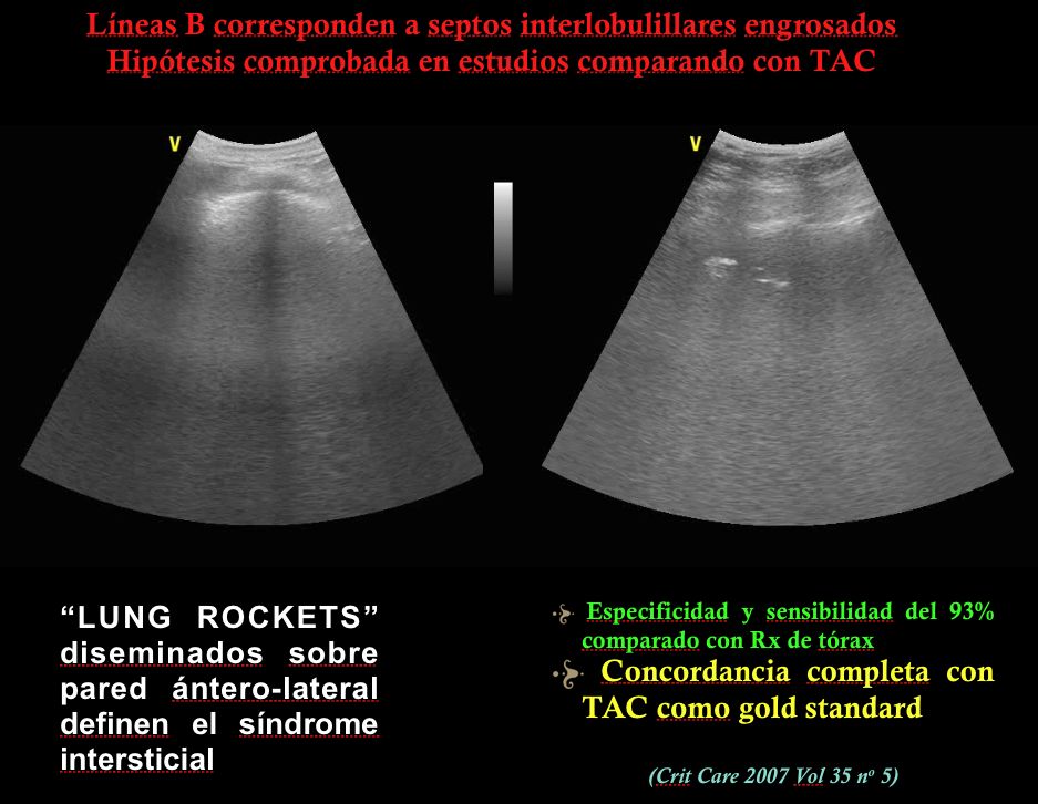 Síndrome intersticial - Ecografía Clínica - FESEMI