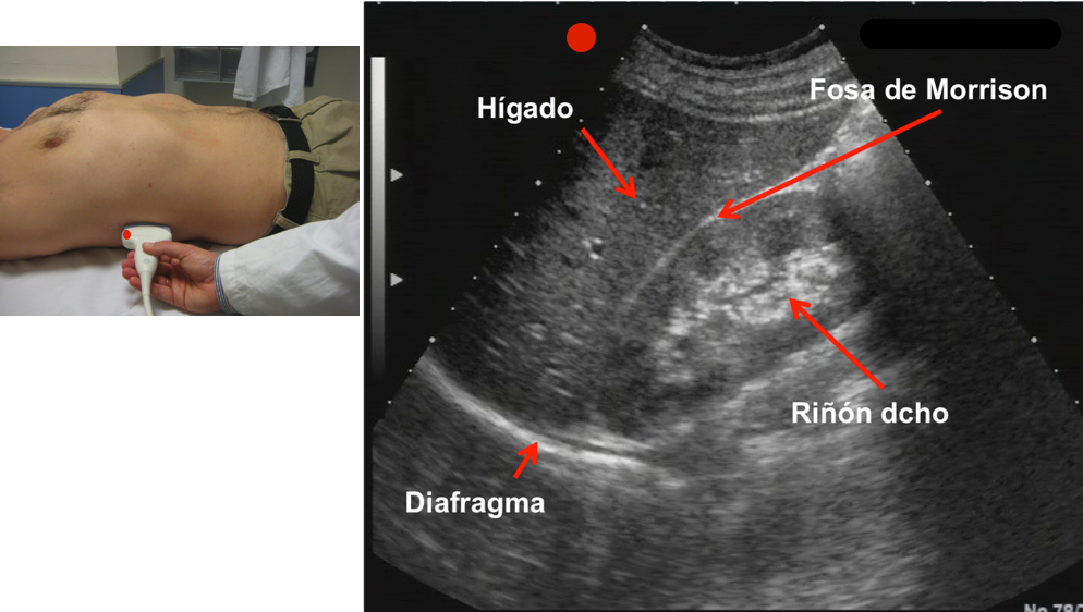 Visualización de la fosa de Morrison - Ecografía Clínica - FESEMI